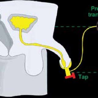 The Basic Principle Of Condom Catheter Technique Flow Is Interrupted