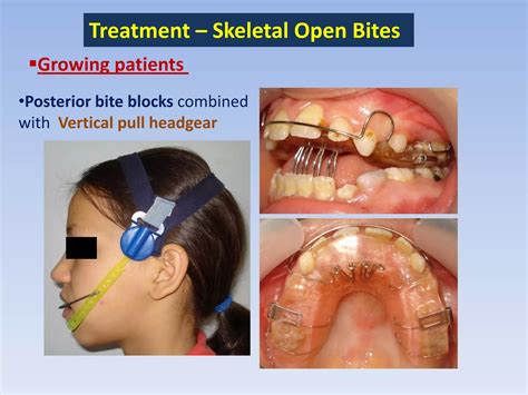 Anterior Open Bite Treatment Deciduous And Mixed Dentition Slide Pdf