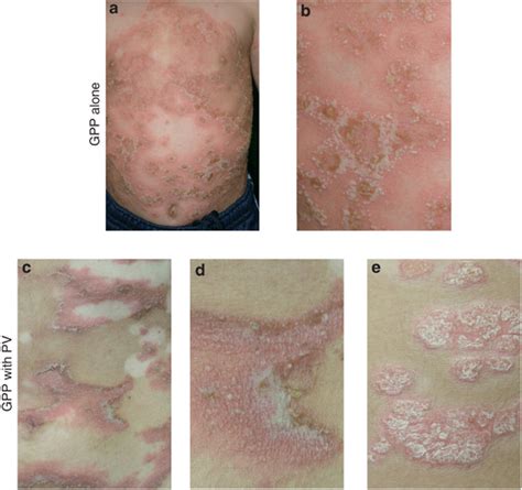 Representative Clinical Features Of The Two Subtypes Of Generalized