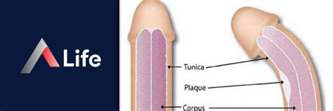 Penile Plication Surgery A Life Health Group