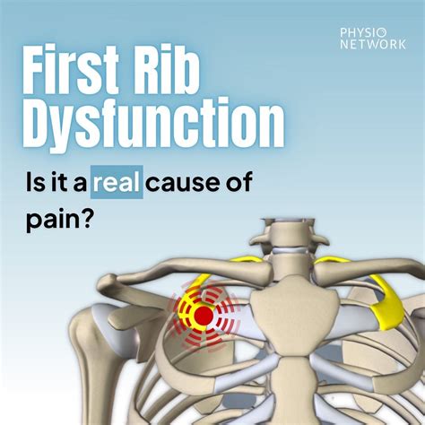 Physio Network On Linkedin 🤨 First Rib Dysfunction ⁠ ⁠ 👆🏻 Ever Heard About It⁠ ⁠ 💡 Want To…