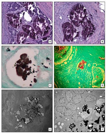 Ijms Special Issue Calcification In Human Pathology