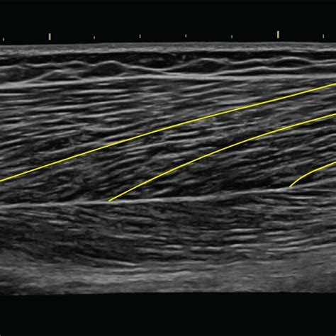 Representative Ultrasound A B Mode Image Of The Mid Belly Biceps