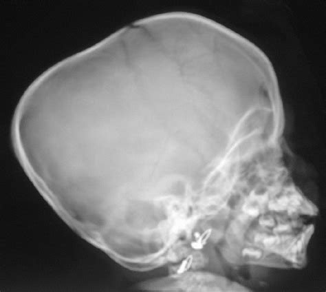 Skull Deformity 15 Buyxraysonline