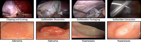 self supervised learning for endoscopic video analysis