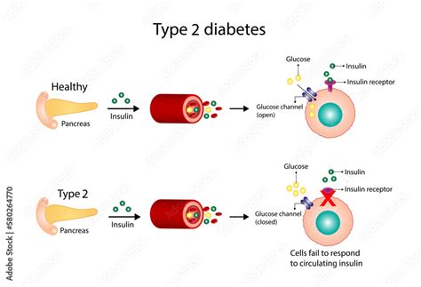 Type 2 Diabetes Insulin
