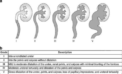 International Classification Of Vesicoureteral Reflux11 Download
