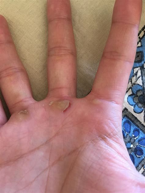 Hey Guys I Had A Callus Tear On Me For The First Time Looking For