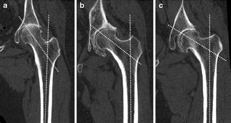 The Centrum Collum Diaphyseal Ccd Angle Is Measured On Download Scientific Diagram