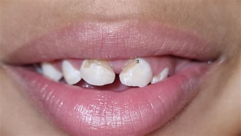 Is This Teeth Decay Or Are They Just Getting Ready To Fall Out R