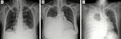 Grade Of Pleural Effusion A Mild Pleural Effusion B Moderate