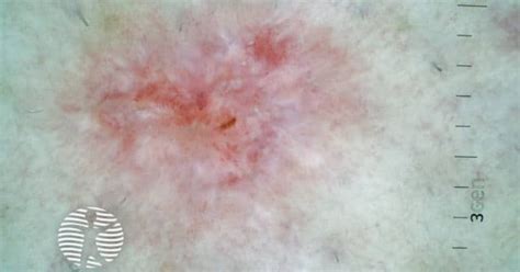 Superficial Basal Cell Carcinoma Dermoscopy Image