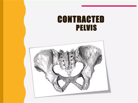 Cpd And Contracted Pelvis Pptx