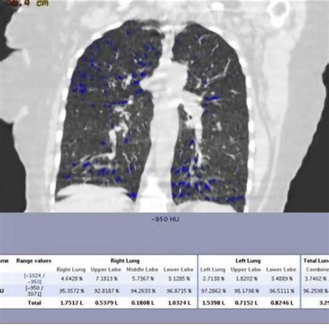The Medical Research Council American Thoracic Society Dyspnea Grading Download Table