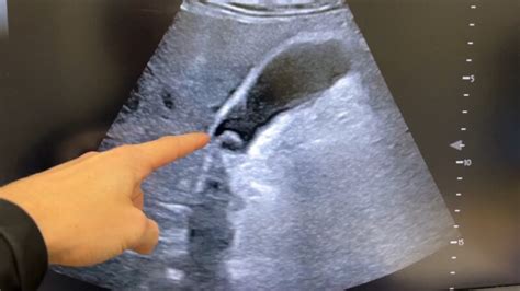 Contracted Gallbladder Diagnosis And Treatment Iaas Med