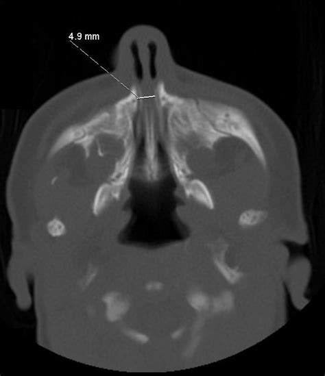 Congenital Nasal Piriform Aperture Stenosis Eurorad