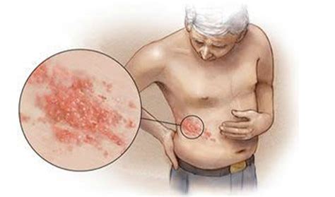 بررسی علائم زونا و 3 درمان زونا به طب سنتی