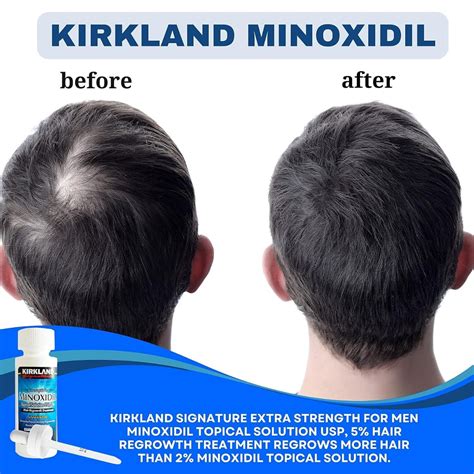 Buy Kirkland Minoxidil 5 Topical Solution 60ml Extra Strength Hair Regrowth Treatment For Men