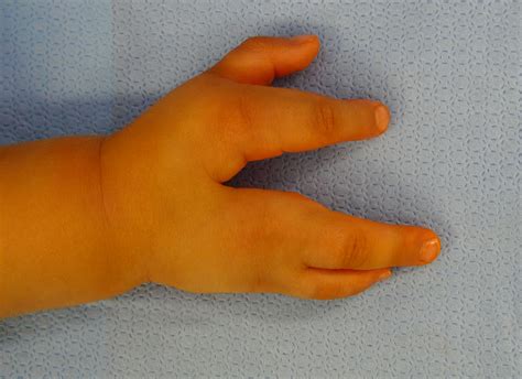 Cleft Hand