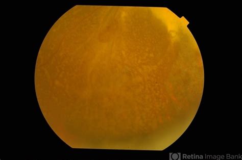 Salmon Patch Retina Image Bank