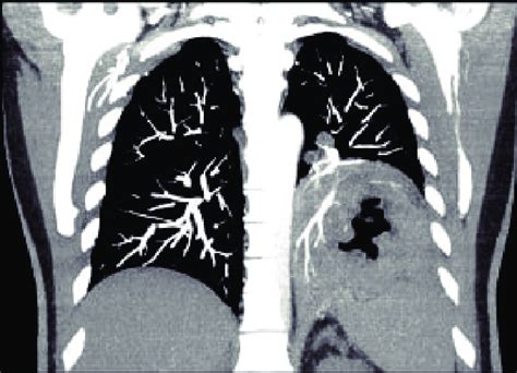 Cta Revealing An Intrapulmonary Abscess In The Left Lower Lung Cta