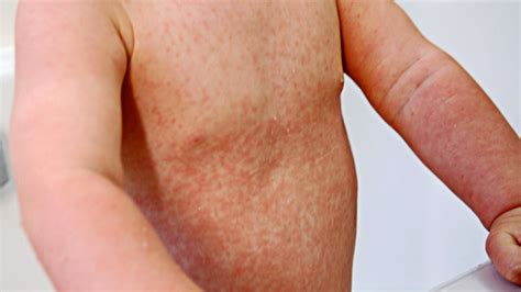 Kry Utslett Hos Barn Symptomer årsaker Og Behandling Med Bildeguide