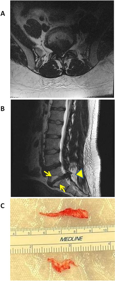 Representation Of A Severe Case Of Lumbar Disc Herniation And Extrusion