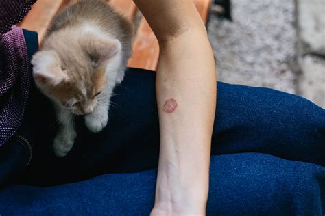 How Contagious Is Ringworm From Cats To Humans At Carolann Ness Blog