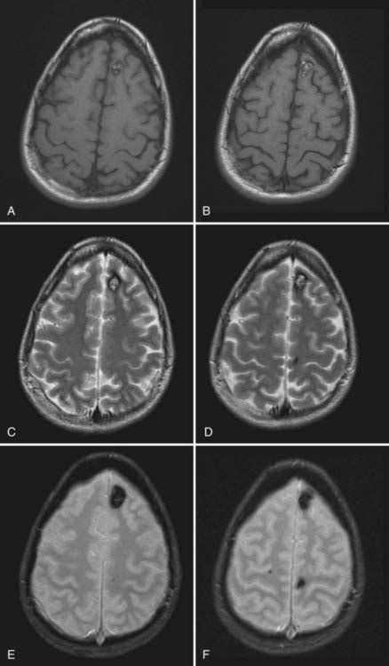 Natural History Of Cavernous Malformations Neupsy Key