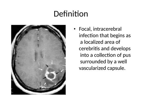 Cerebral Abscess Dvdfzvbsdbgdfndfndfgndfndfg Pptx