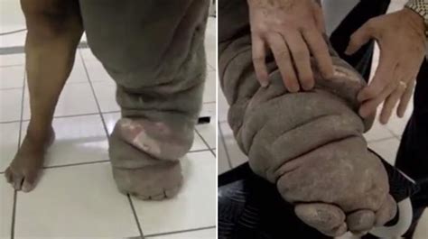 Elephantitis Of The Testicles