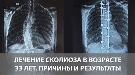 Сколиоз грудного отдела позвоночника операция в 33 года Диагностика и лечение сколиоза