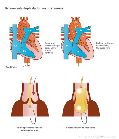 Cardiology Aortic Stenosis