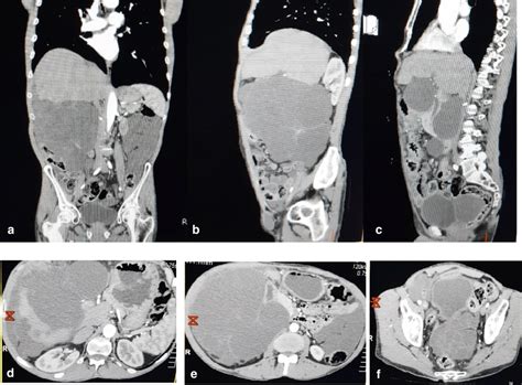 A Contrast Msct Of The Abdomen And Pelvis A Coronal View B Sagittal