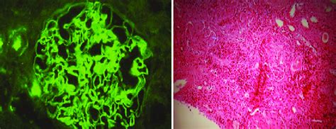 A Immunofluorescence Was Performed On 3 Glomeruli They Were All