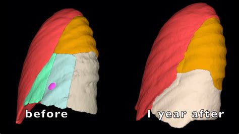 3d Ds Ep 7 Left S8 S9 Segmentectomy Youtube