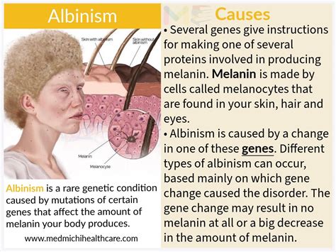 Albinism Causes Medium