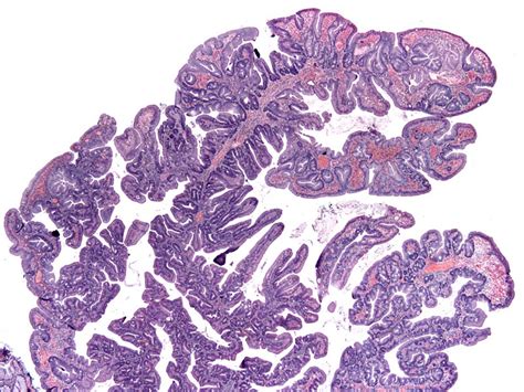 Serrated Polyps Quiz