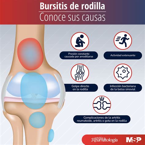 Revista Mspreumatología La Bursitis De Rodilla Es La Inflamación