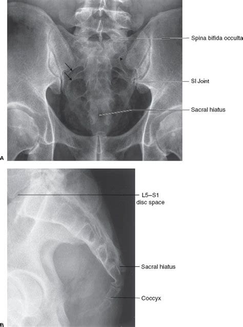 Sacrum Anatomy Xray