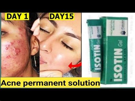 Isotin Gel 10gm Darazpk Buy Online At Best Prices In Pakistan Darazpk