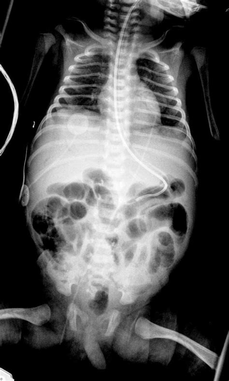 Necrotizing Enterocolitis Buyxraysonline