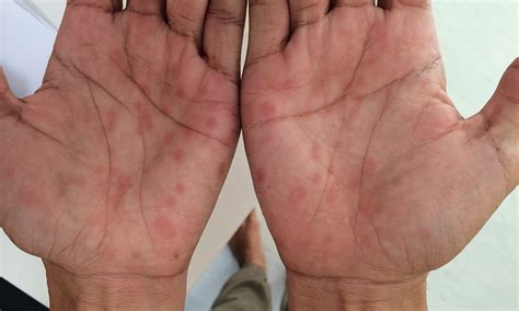 Syphilitic Hepatitis An Increasingly Common Presentation Of An Epidemic Disease The Medical