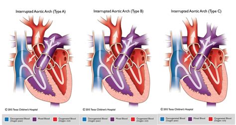Aortic Arch Incidentally Detected Noninfectious Thoracic Aortitis A