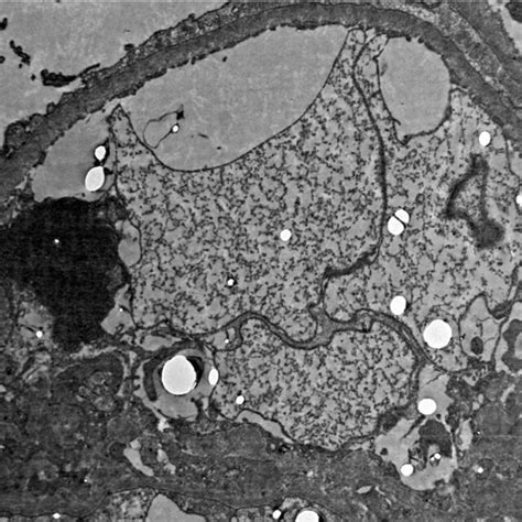 Case 1 Electron Microscopy Glomerulus Image Download Scientific Diagram