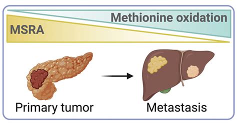 Scientists Find Trigger That Sets Off Metastasis In Pancreatic Cancer
