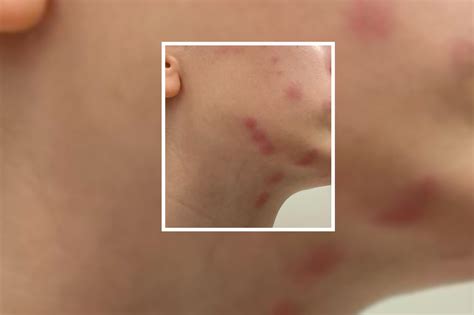 Bed Bug Bites On Face Brown Skin Matters Condition Pictured Bed Bug