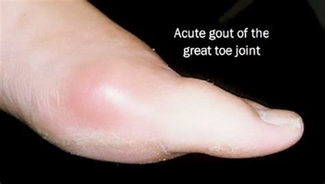 Gout Big Toe Surgery Big Toe Gout Symptoms Causes And Treatments