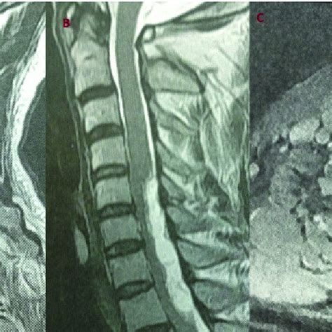 A B C Cervical Mri Taken Preoperatively Download Scientific Diagram