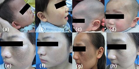 Early Treatment Of Nevus Of Ota Is More Effective Ccid